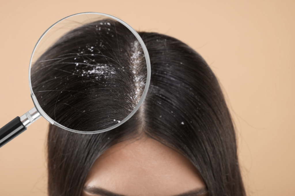 The Ultimate Guide to Dealing with Dandruff